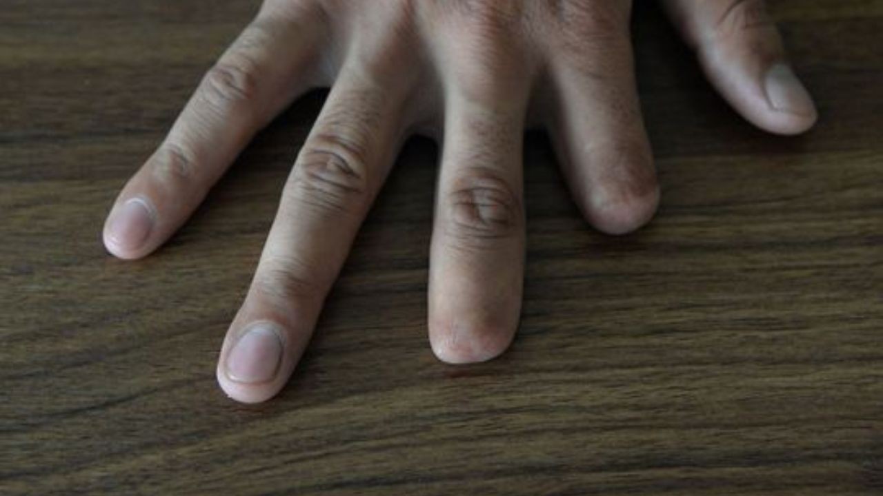 Canada man suffering from THIS rare disease has to get fingers chopped off